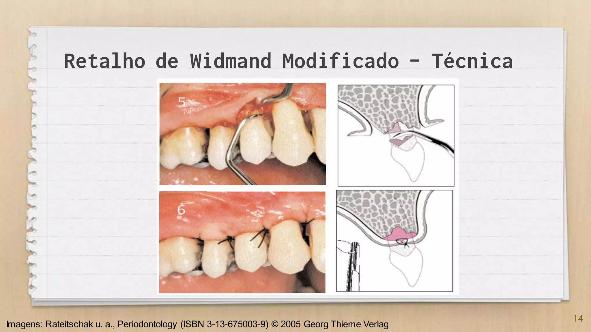 Resumo de Periodontia - Retalho de Widman, Widman Modificado, Kirkland ...