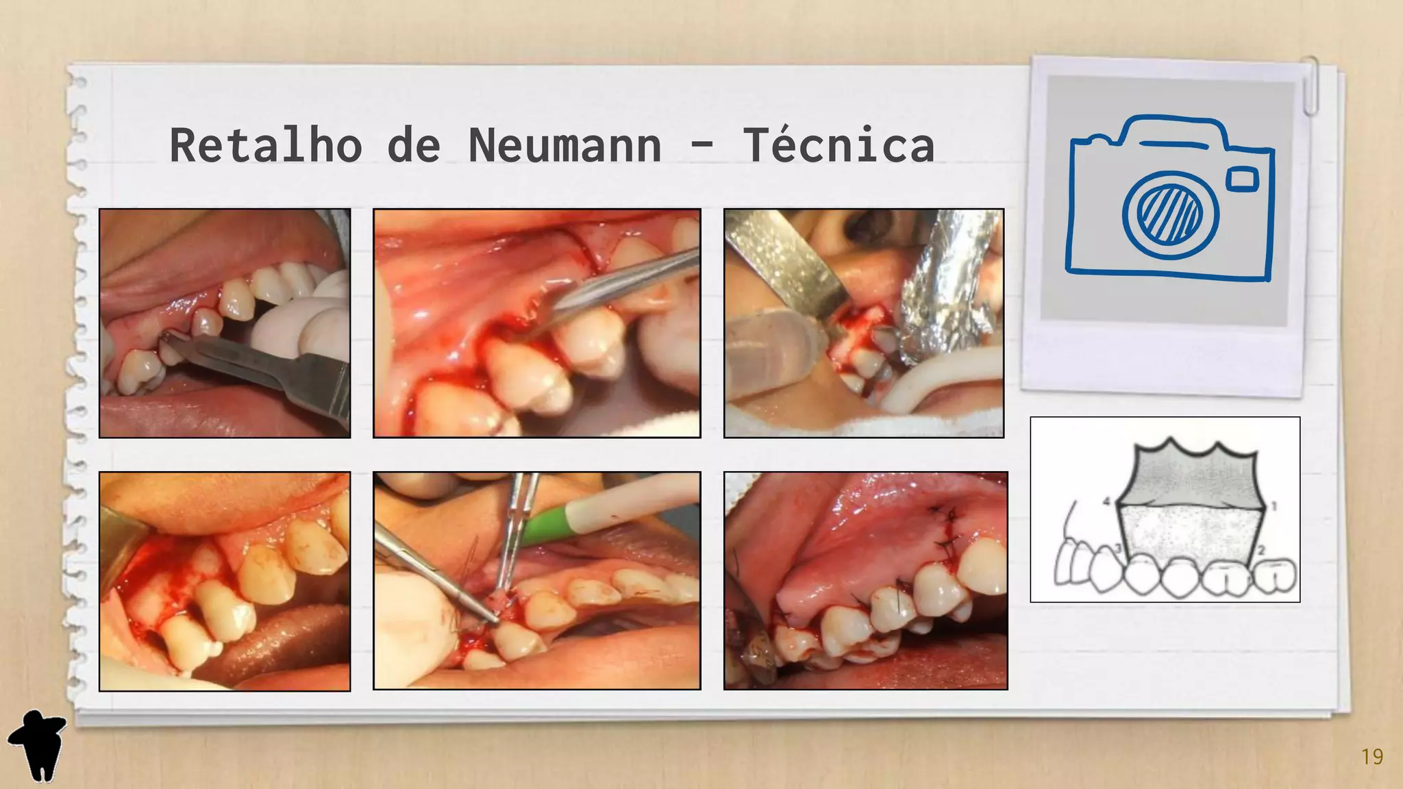 Resumo de Periodontia - Retalho de Widman, Widman Modificado, Kirkland ...
