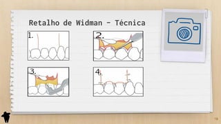 Resumo de Periodontia - Retalho de Widman, Widman Modificado, Kirkland ...