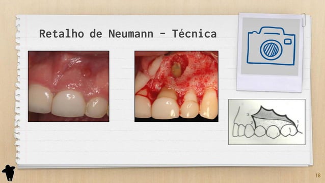 Resumo de Periodontia - Retalho de Widman, Widman Modificado, Kirkland ...