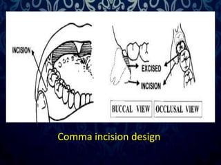 Dentist in pune.(BDS. MDS) - Dr. Amit T. Suryawanshi. Comma Incision ...