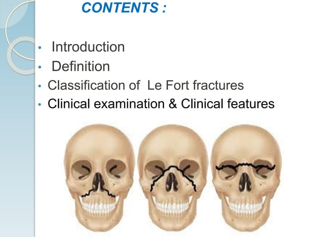 Le fort fracture عيون لطب الاسنان دكتور احمد اسامة هاشم | PPT