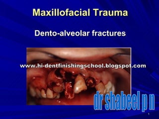 Dento Alveolar Fractures | PPT