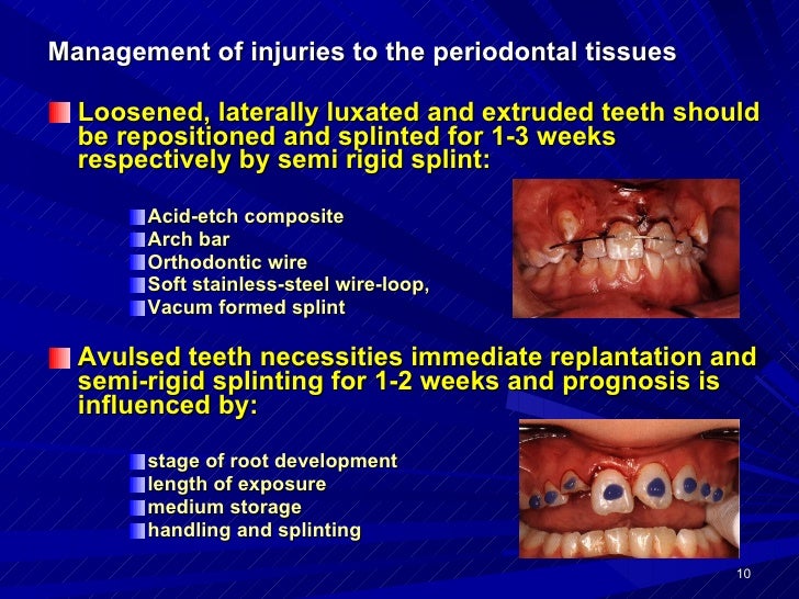 Dento Alveolar Fractures