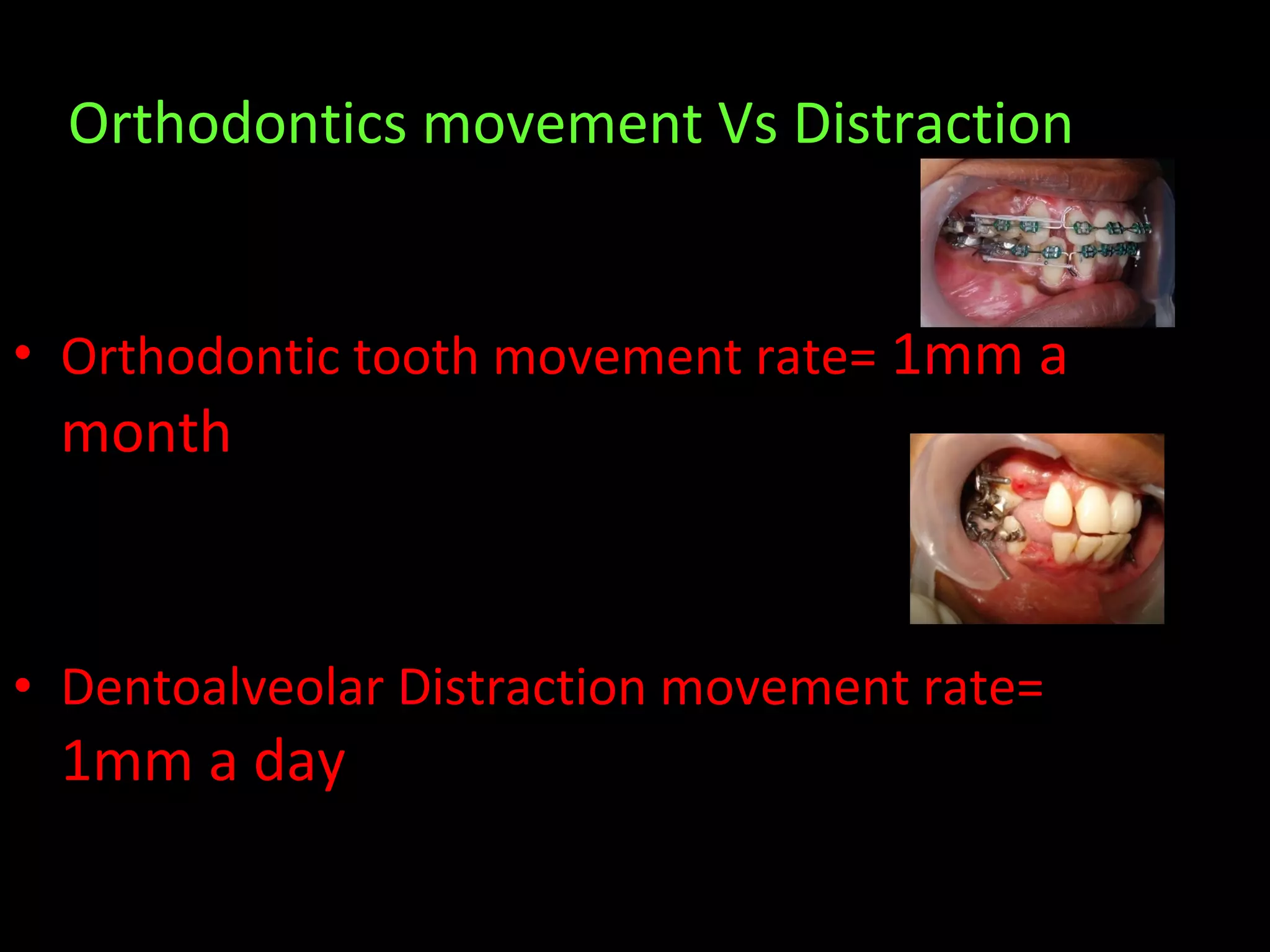 Dentoalveolar distraction cochi ida | PPT