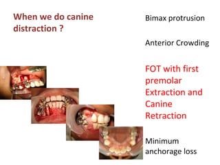 Dentoalveolar distraction cochi ida | PPT