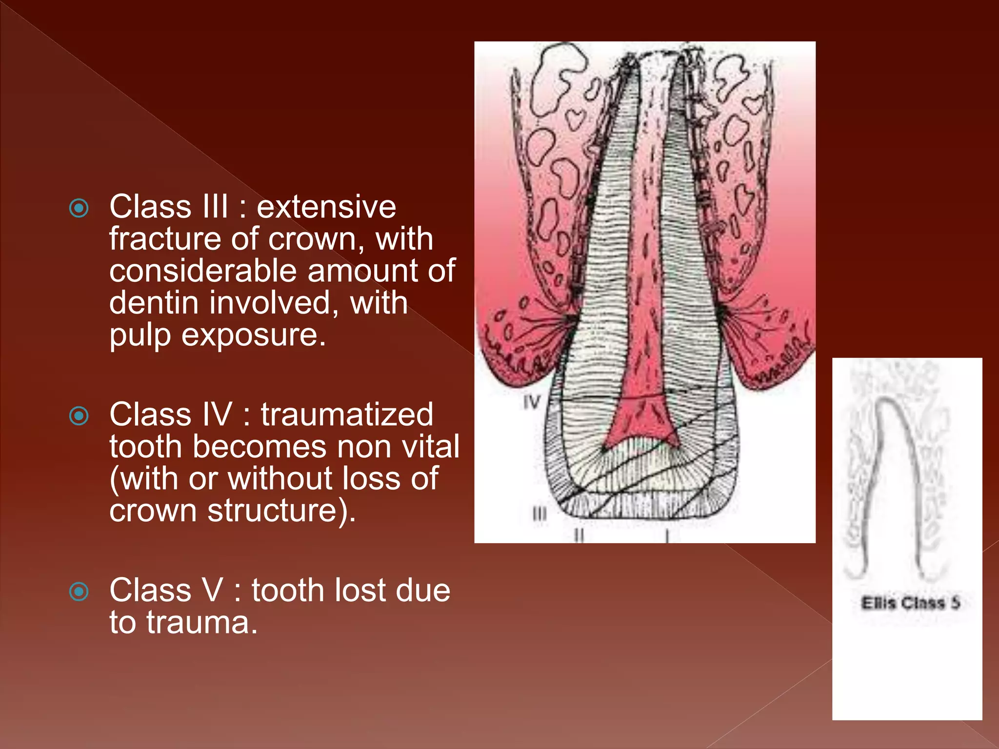 dento alveolar injuries.pptx