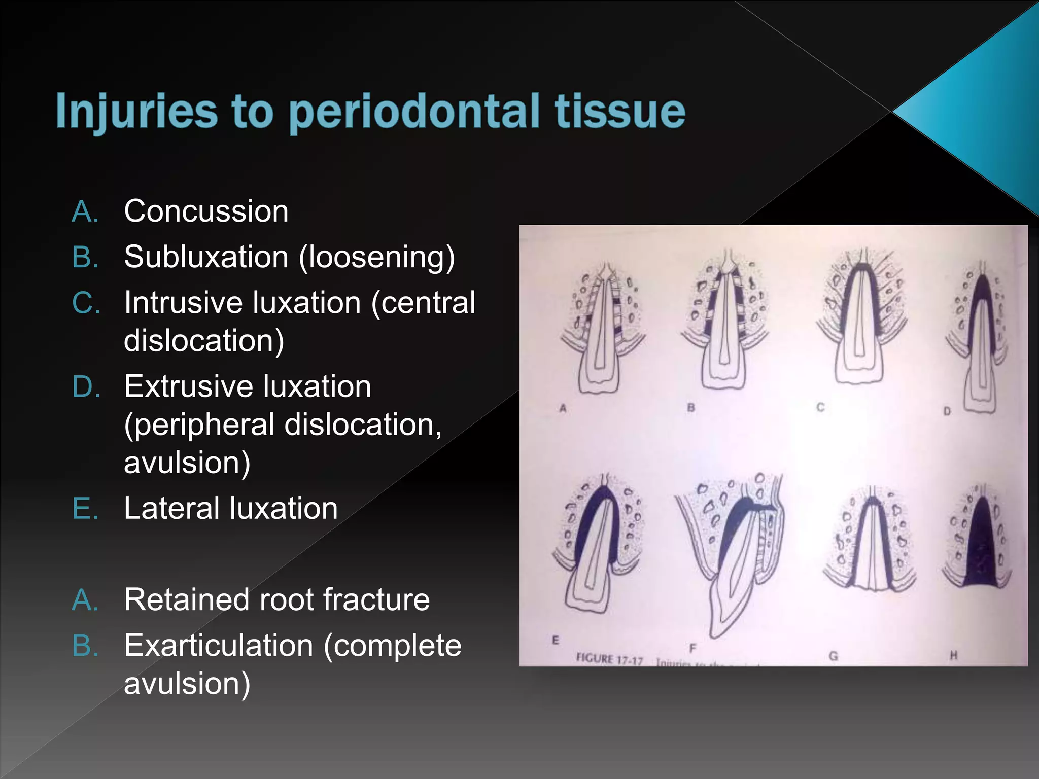 dento alveolar injuries.pptx | Death, Injury, or Military Conflict ...