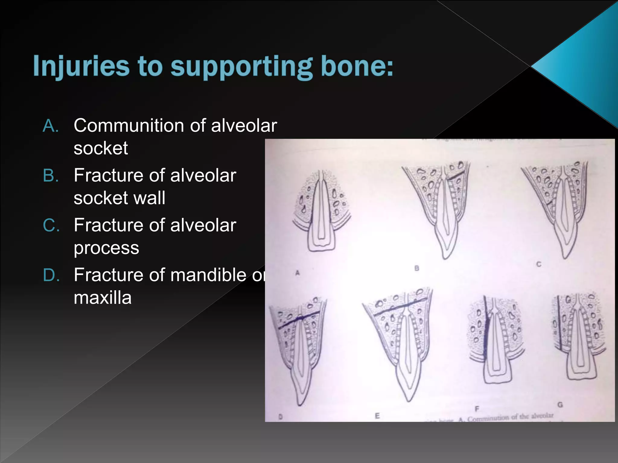 dento alveolar injuries.pptx