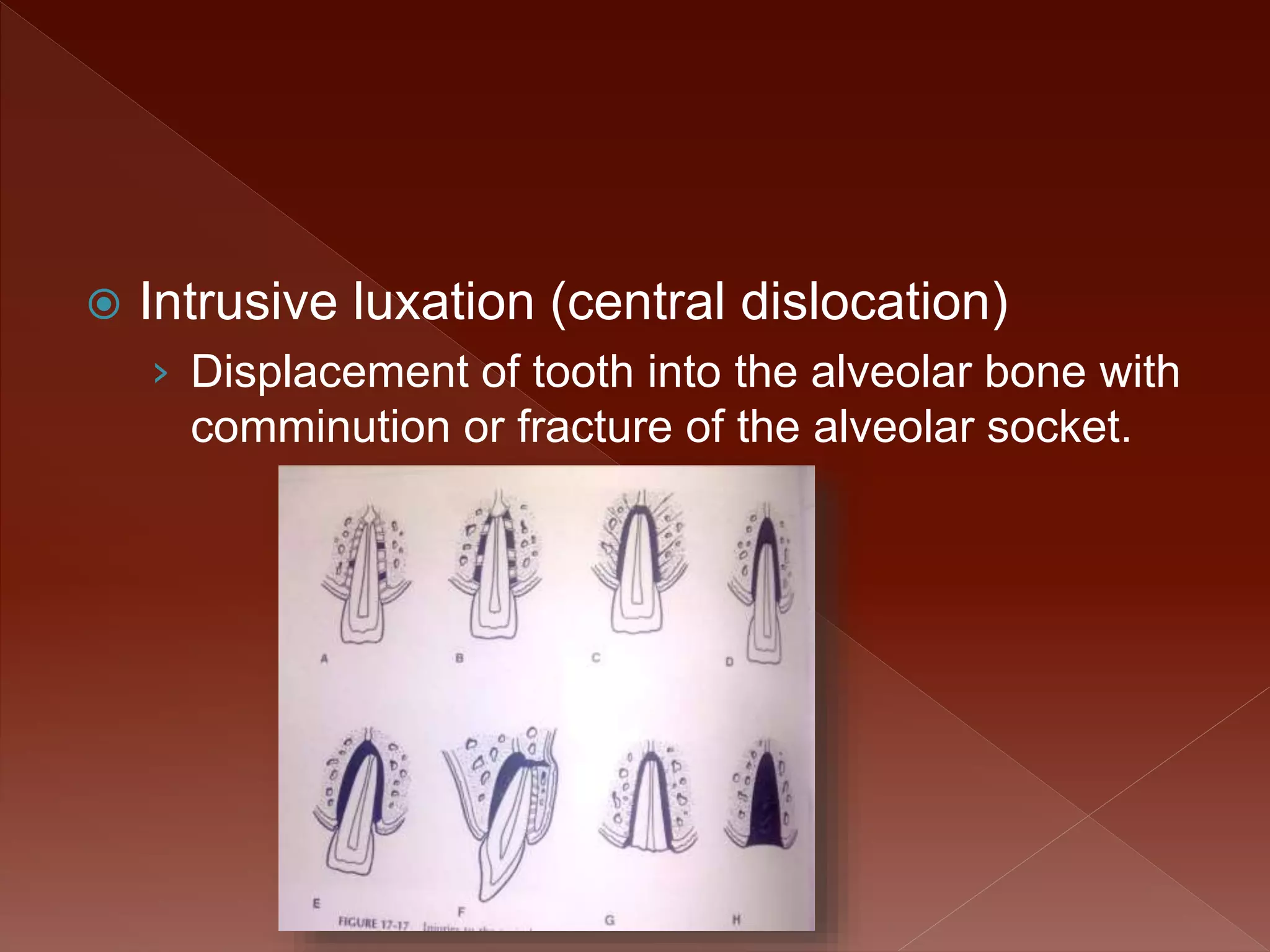 dento alveolar injuries.pptx