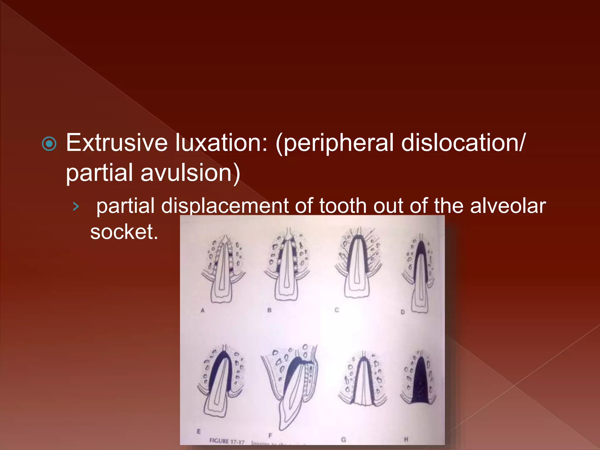 dento alveolar injuries.pptx