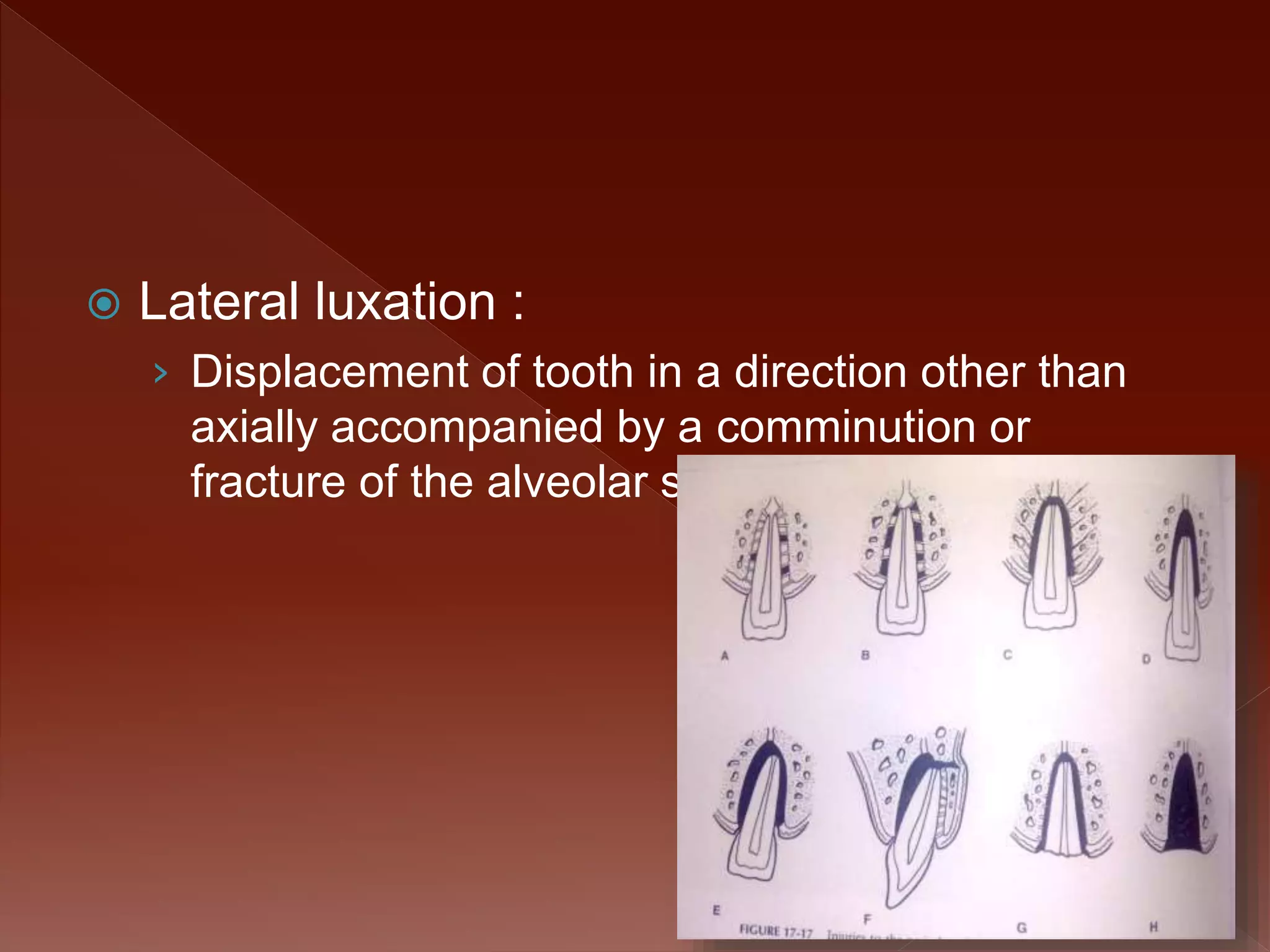 dento alveolar injuries.pptx