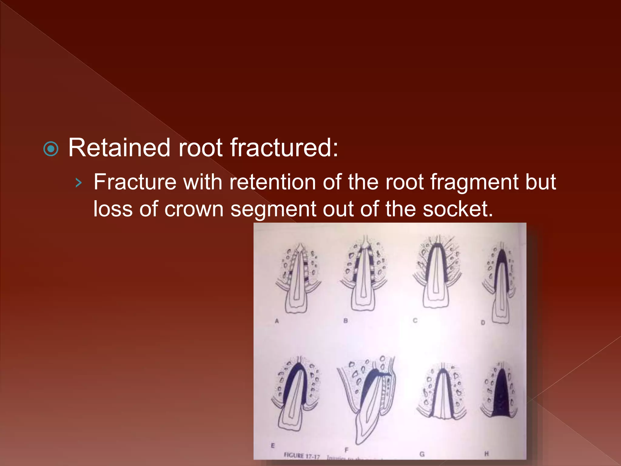 dento alveolar injuries.pptx