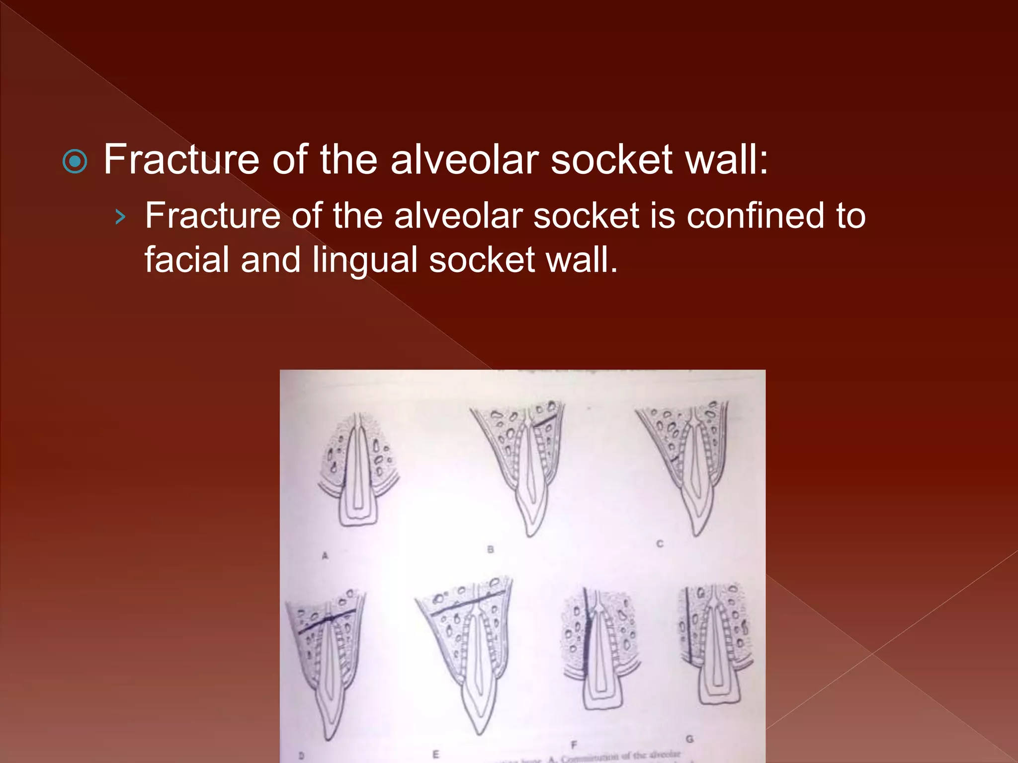 dento alveolar injuries.pptx