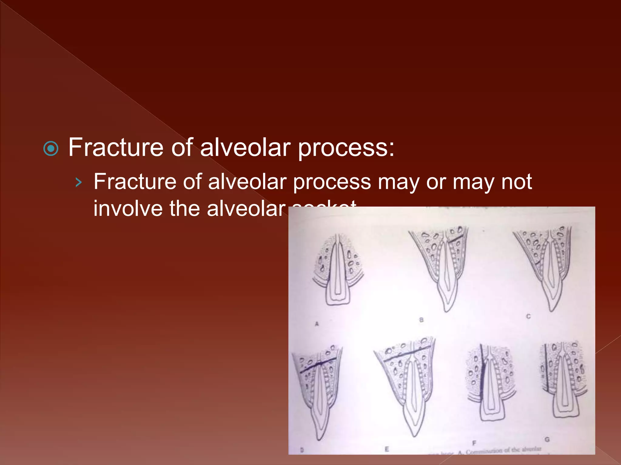 dento alveolar injuries.pptx