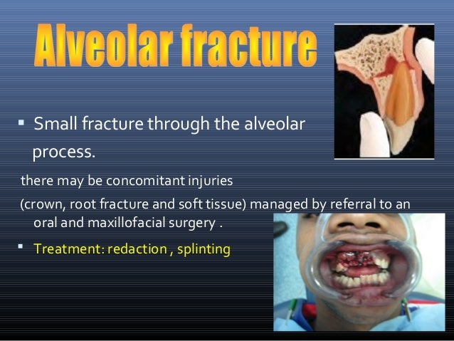 Dentoalveolar injuries ppt