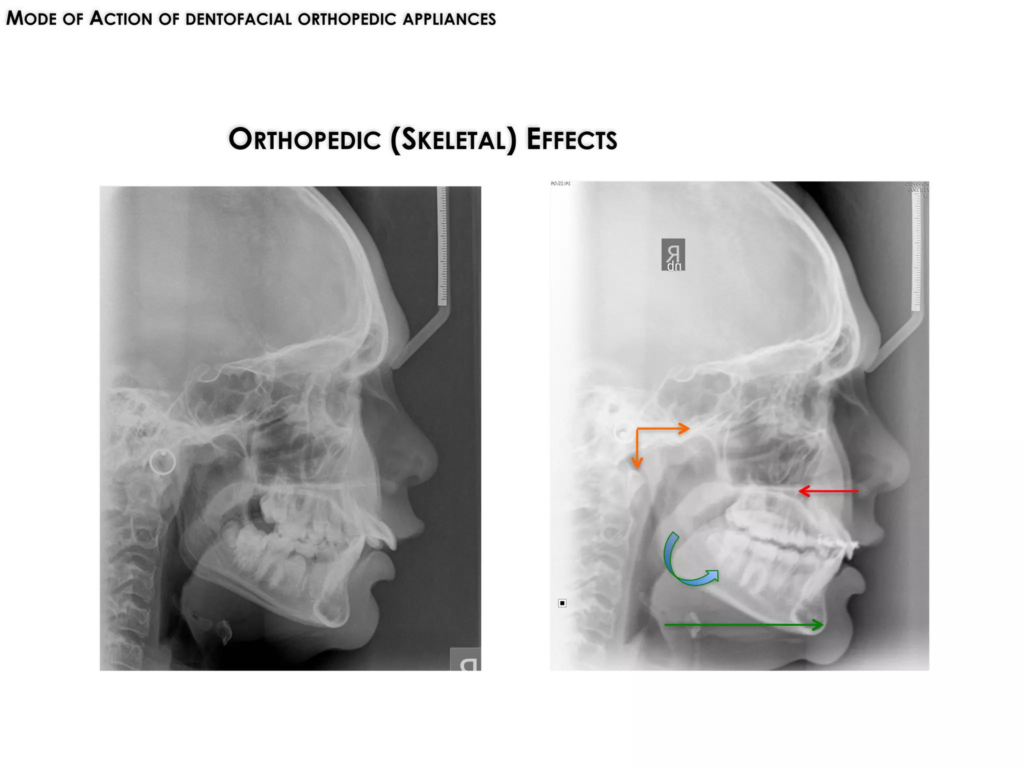Dentofacial Orthopedic Appliance - Twin Block | PDF