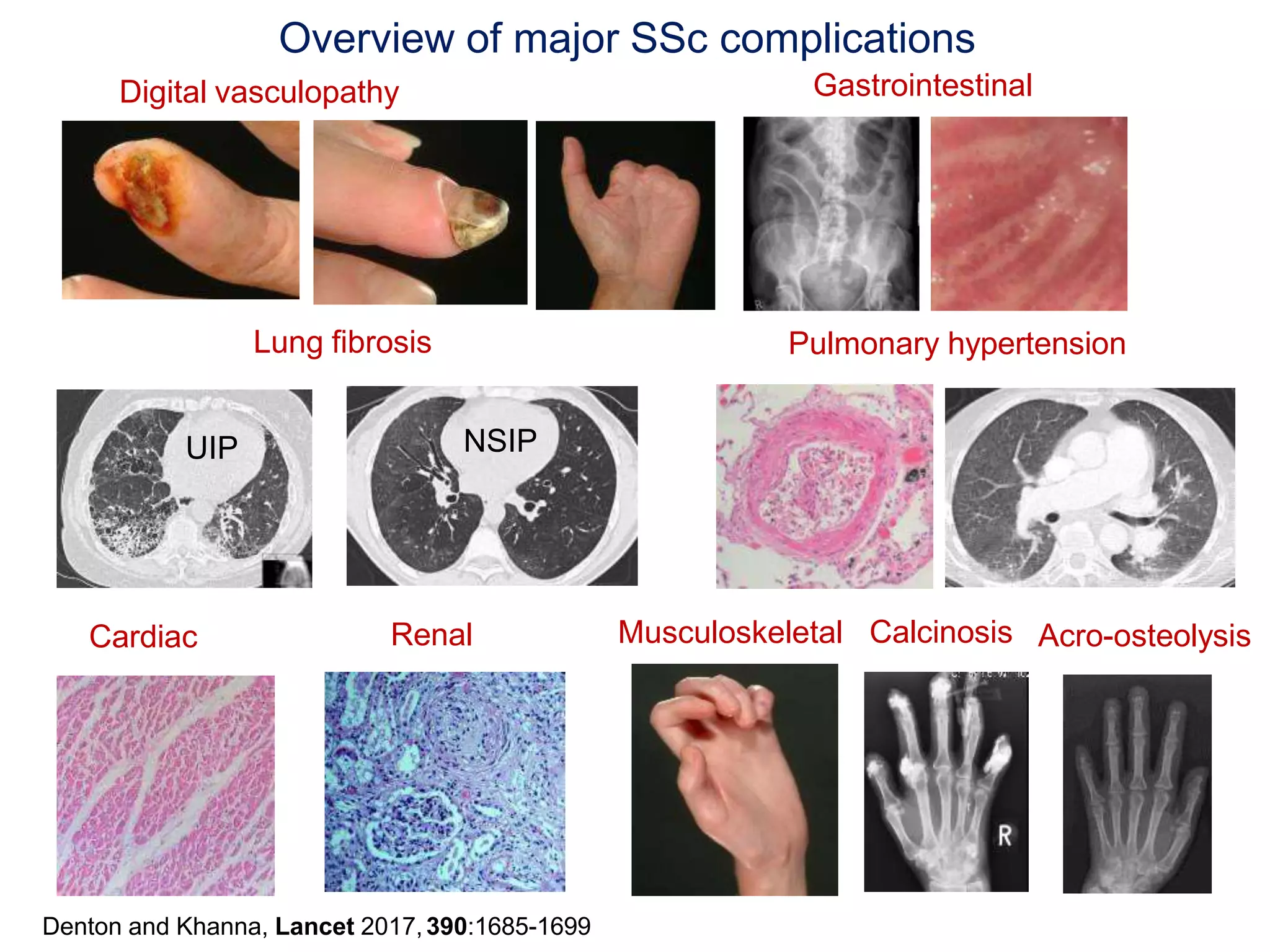The State of Scleroderma Clinical Trials | PPTX