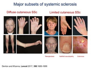 The State of Scleroderma Clinical Trials | PPTX