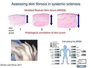 The State of Scleroderma Clinical Trials | PPTX