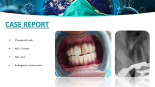 apexification using biodentine | PPTX