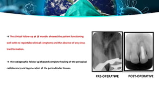 apexification using biodentine | PPTX