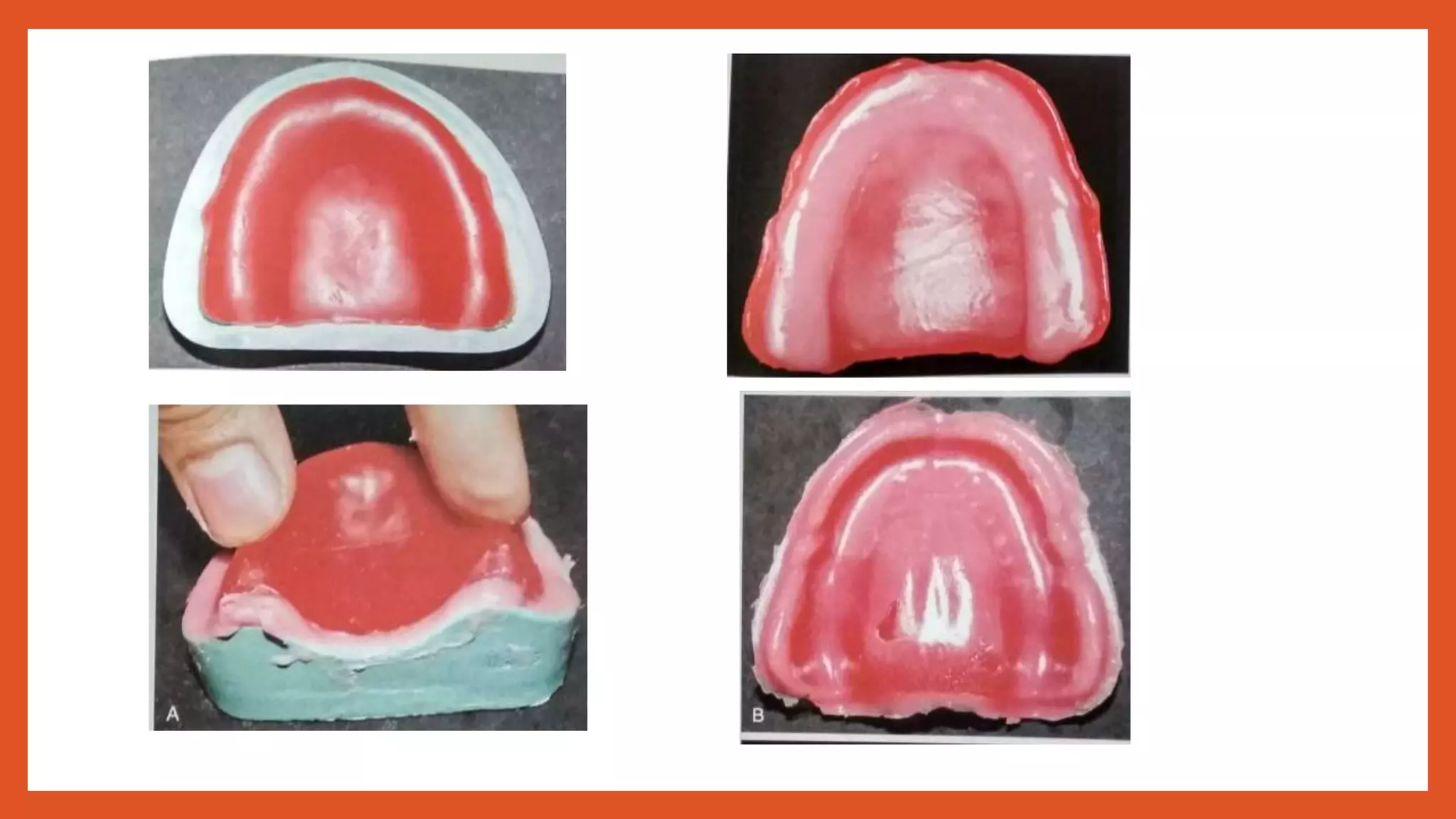 Denture base and occlusal rims | PPTX