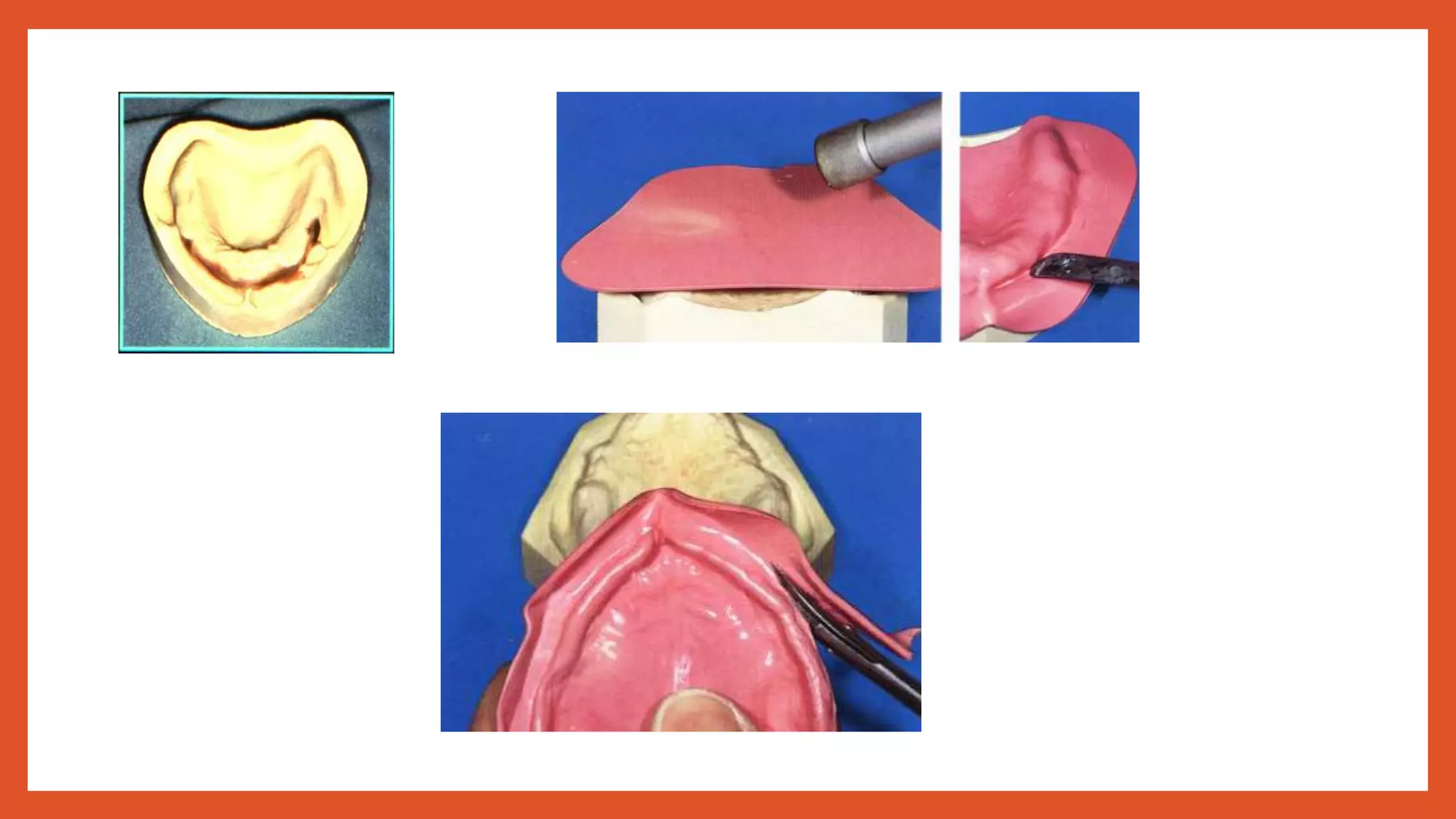 Denture base and occlusal rims | PPTX