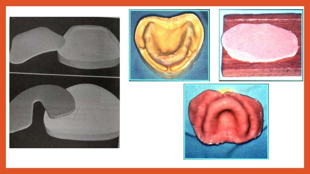 Denture base and occlusal rims | PPTX