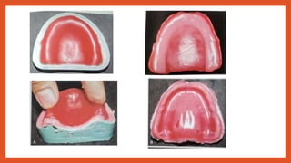 Denture base and occlusal rims | PPTX