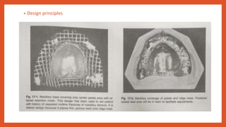 Denture base and occlusal rims | PPTX