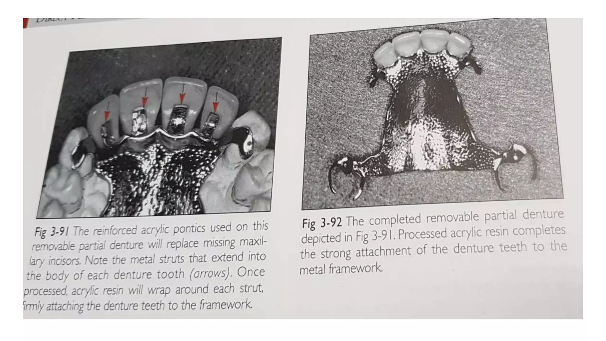 Denture base considerations in rpd | PPTX