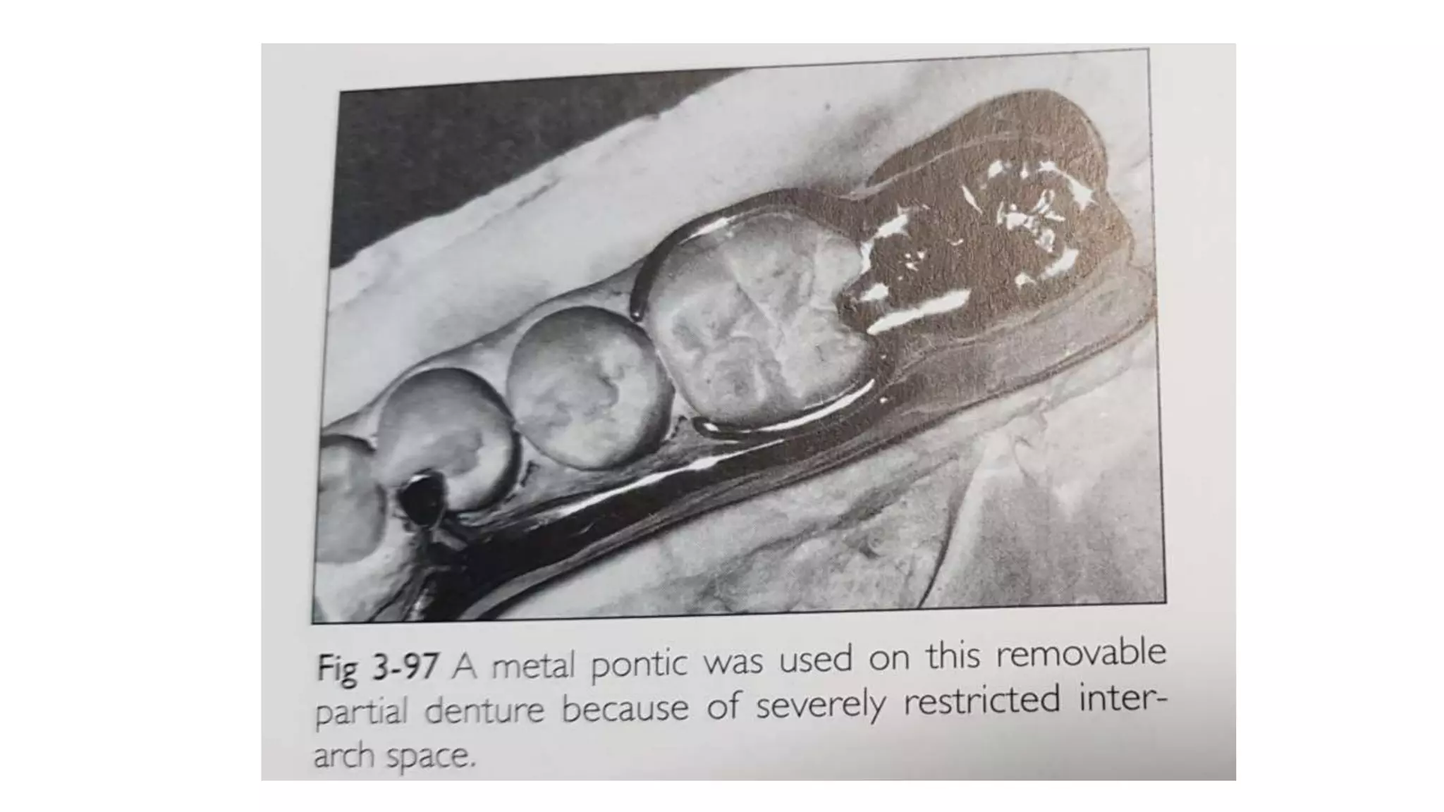 Denture base considerations in rpd | PPTX