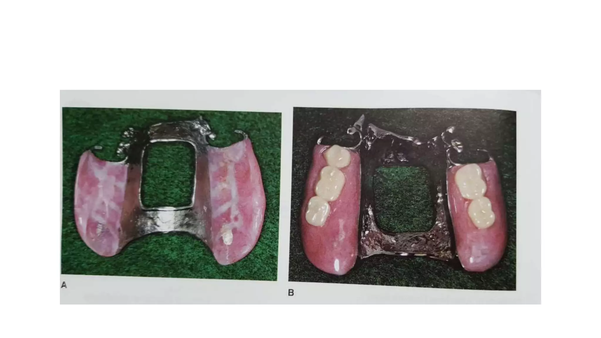 Denture base considerations in rpd | PPTX