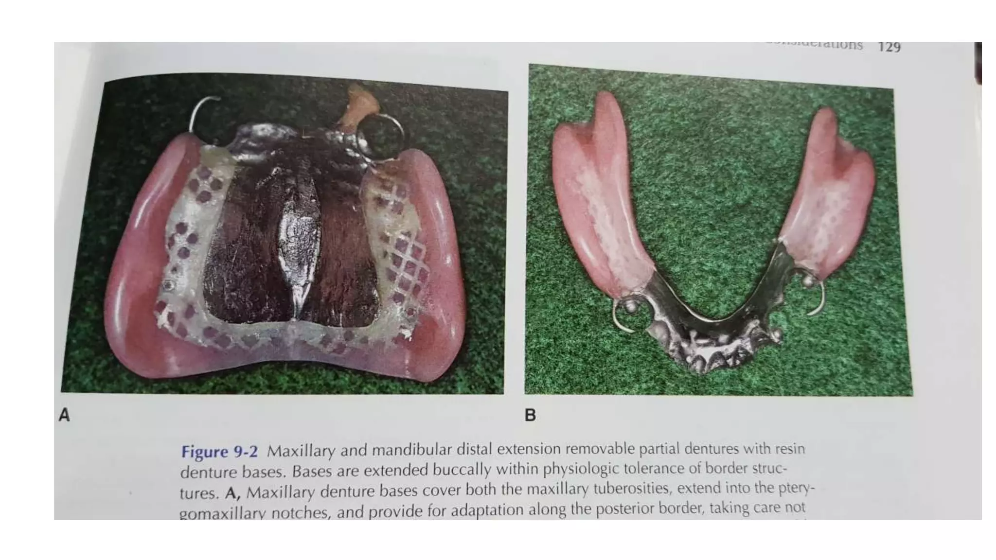 Denture base considerations in rpd | PPTX