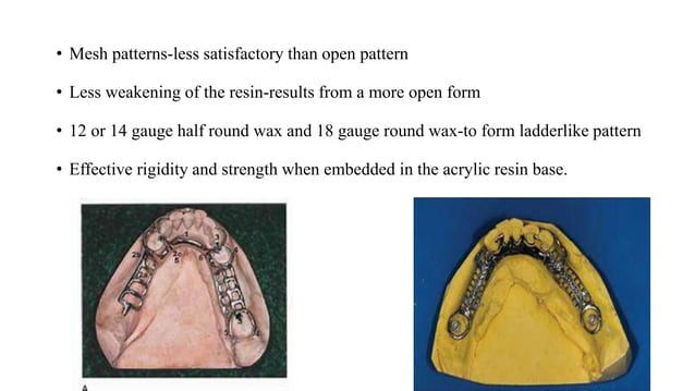 Denture base considerations in rpd | PPTX | Oral care | Personal Care