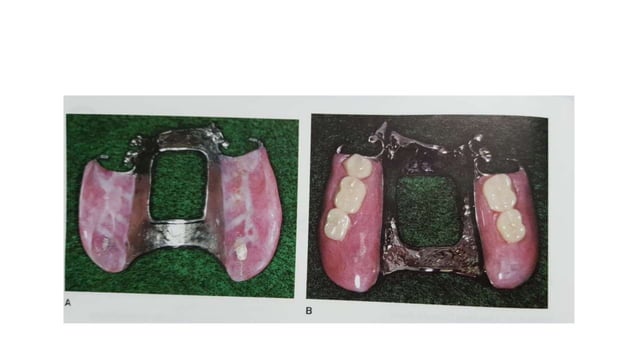 Denture base considerations in rpd | PPTX | Oral care | Personal Care