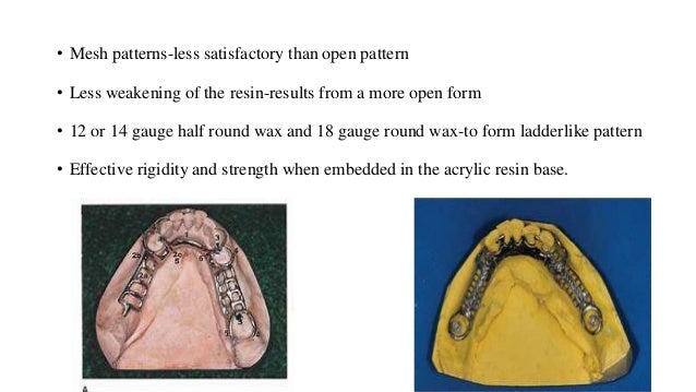 Denture base considerations in rpd