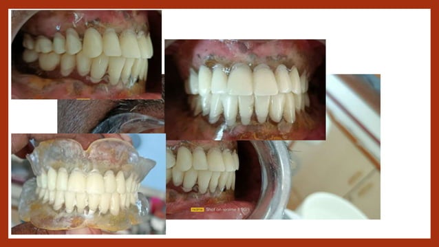Denture base resins materials and its mechanism of action | PPT