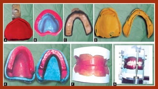 Denture base resins materials and its mechanism of action | PPTX