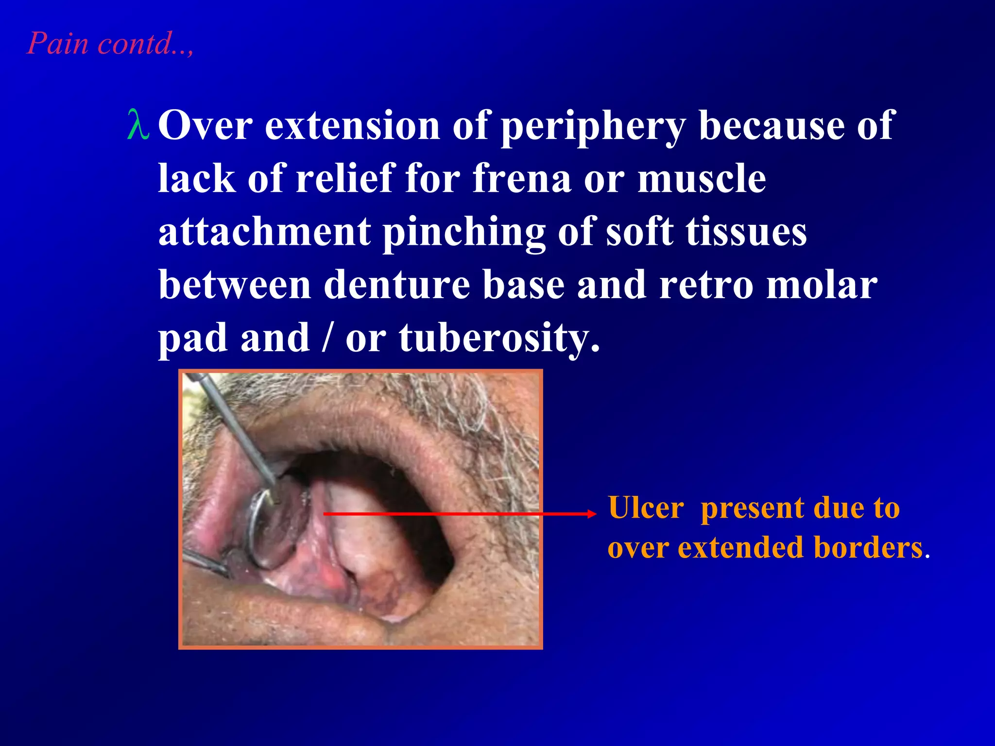 Denture complaints (1).ppt