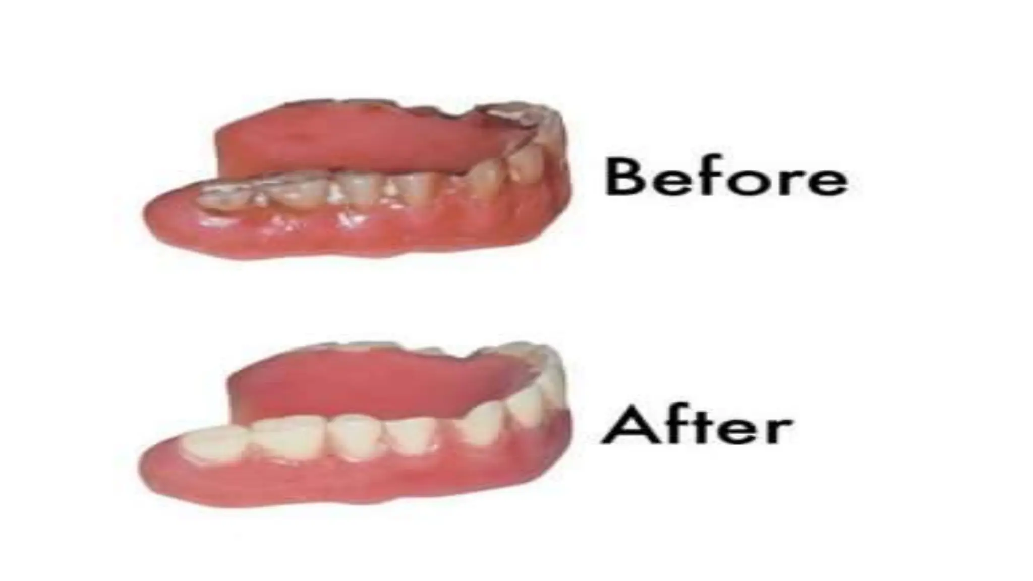 DENTURE COPYING PROCEDURES IN PROSTHETIC | PPTX