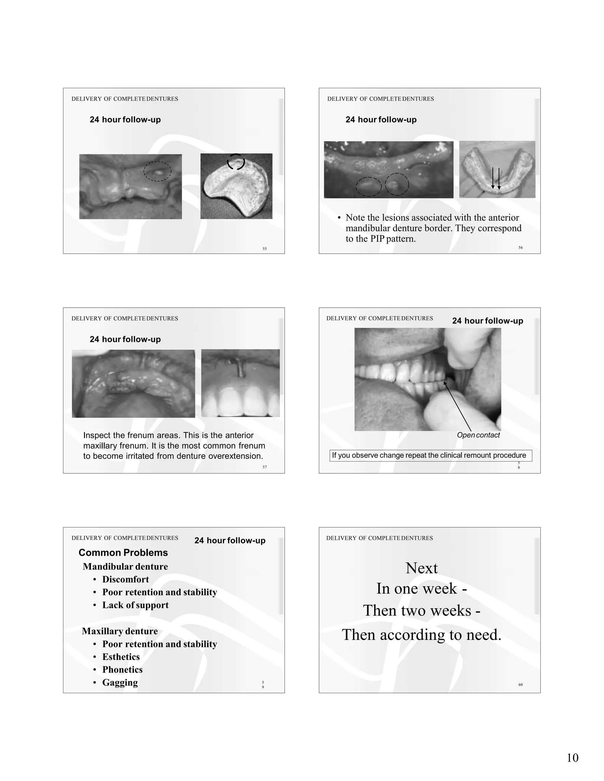 Denture delivery | PPTX