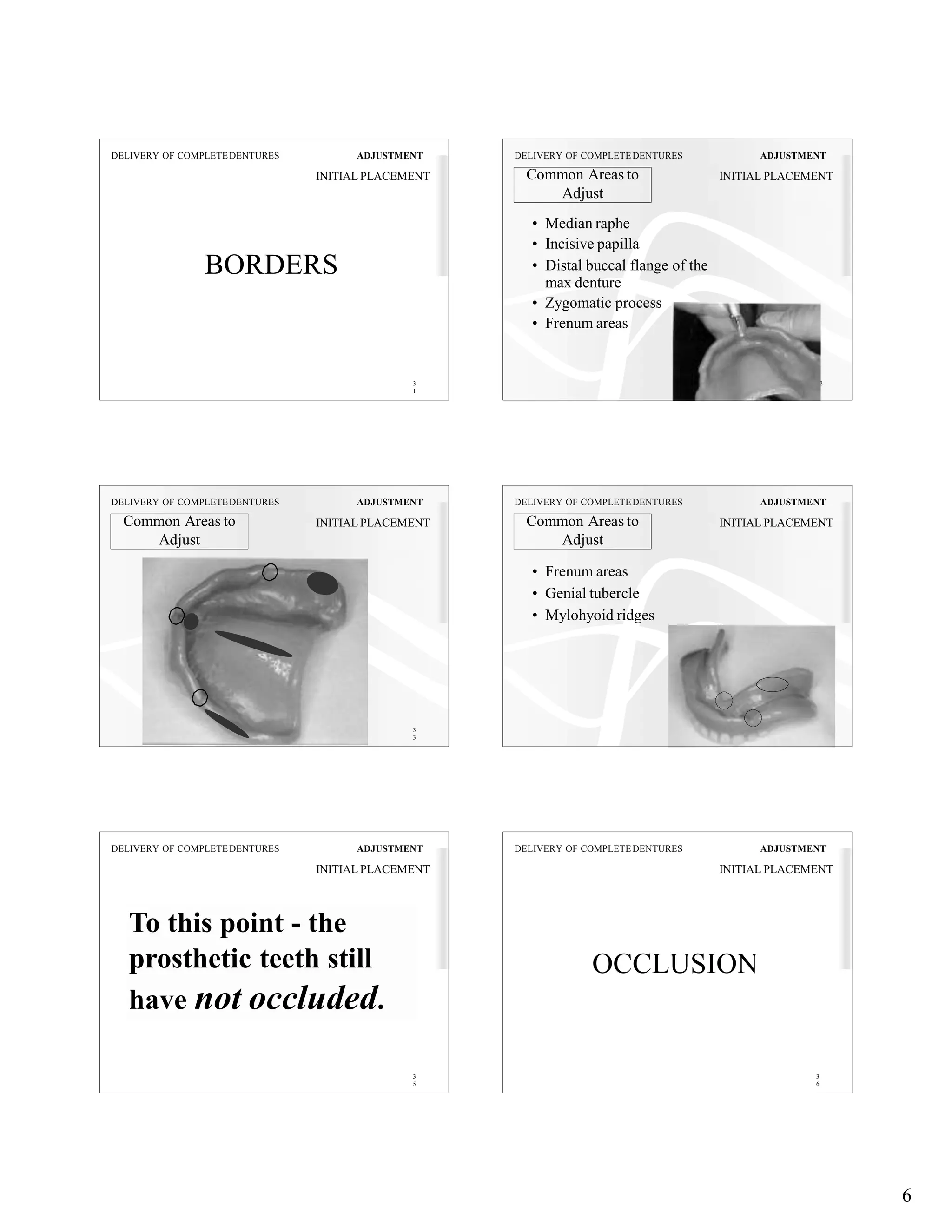 Denture delivery | PPTX