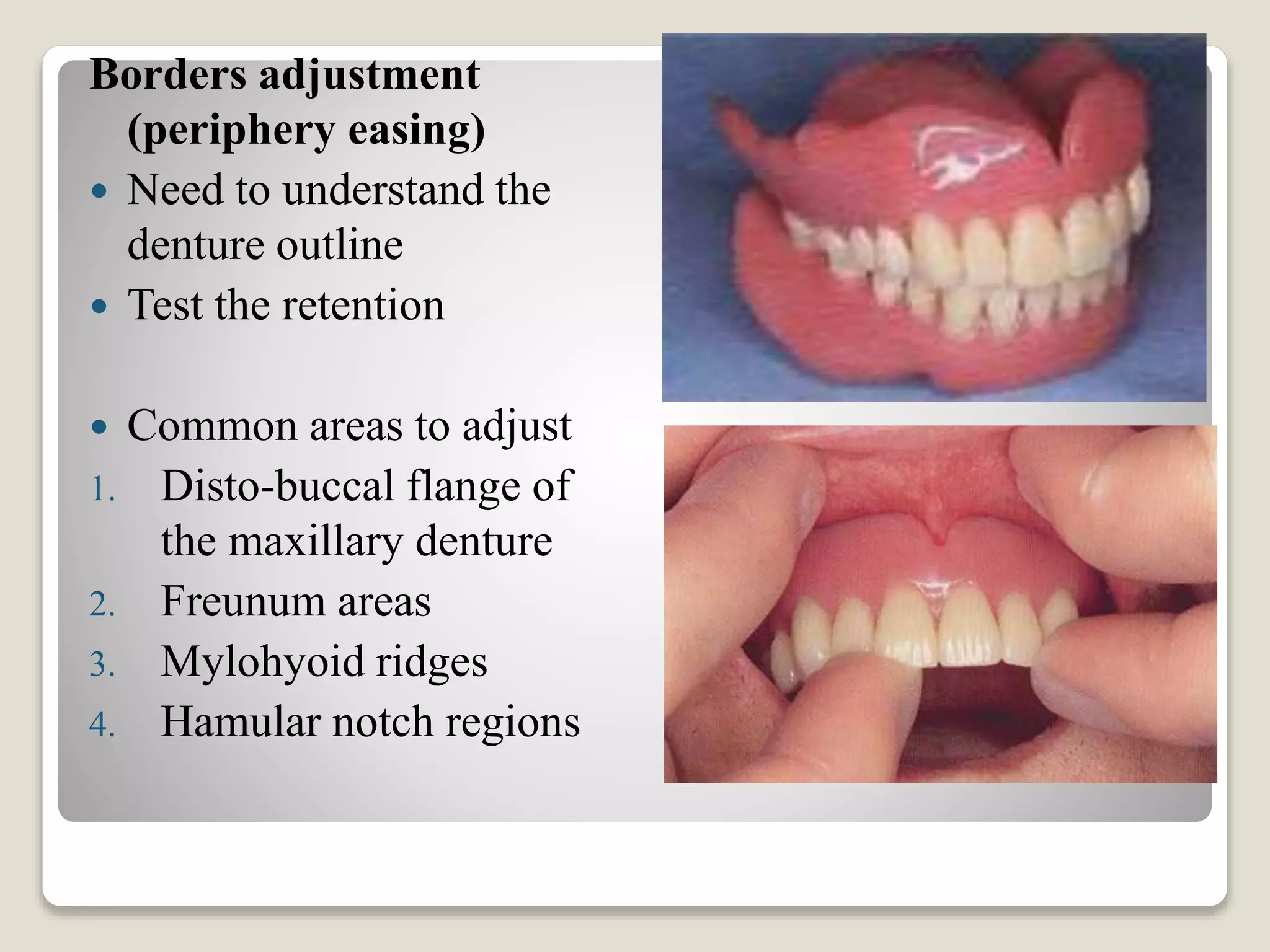 Before delivering finished dentures | PPTX | Dental Health | Diseases ...