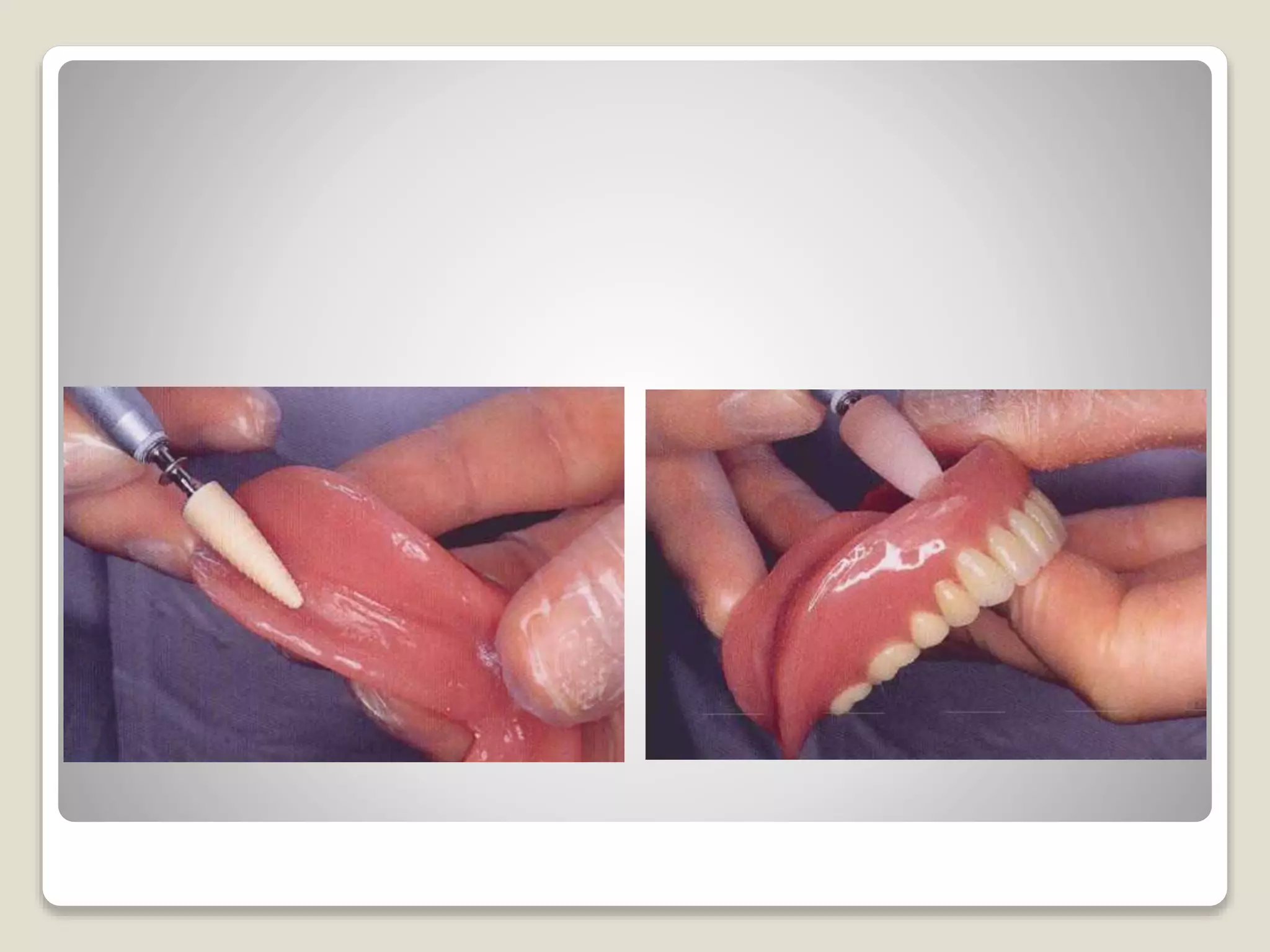 Before delivering finished dentures | PPT