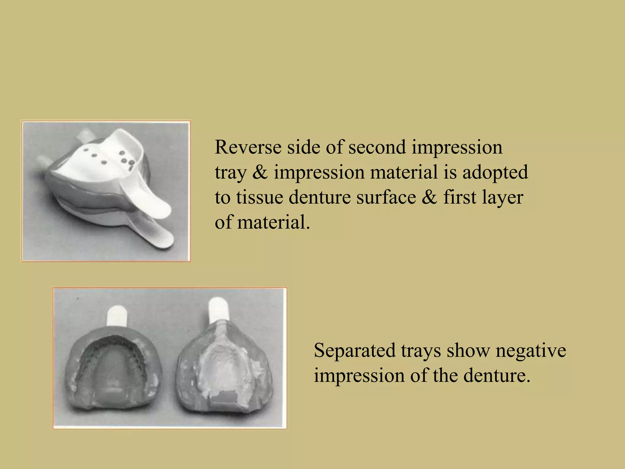 Denture duplication_112502.ppt