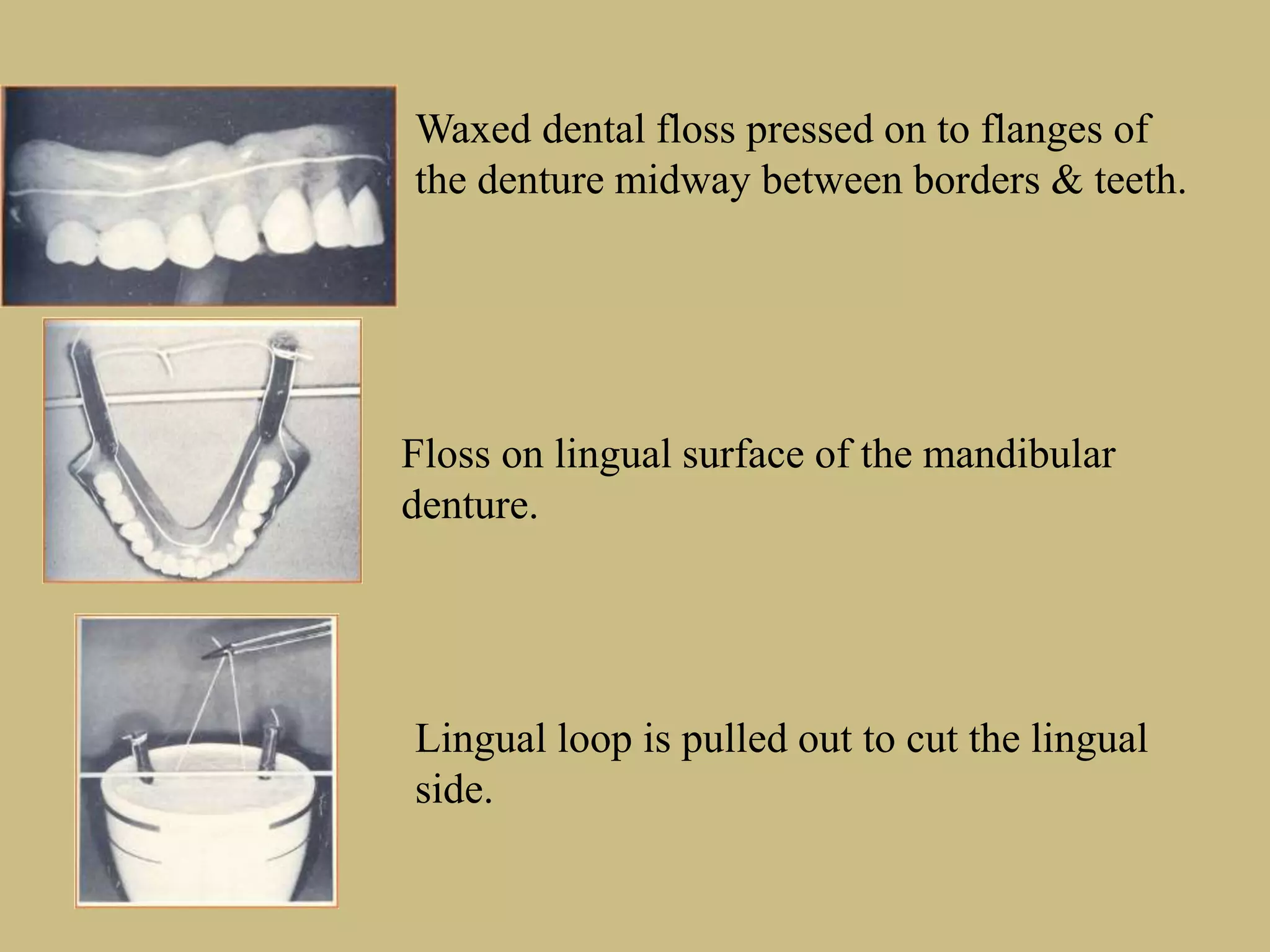 Denture duplication_112502.ppt