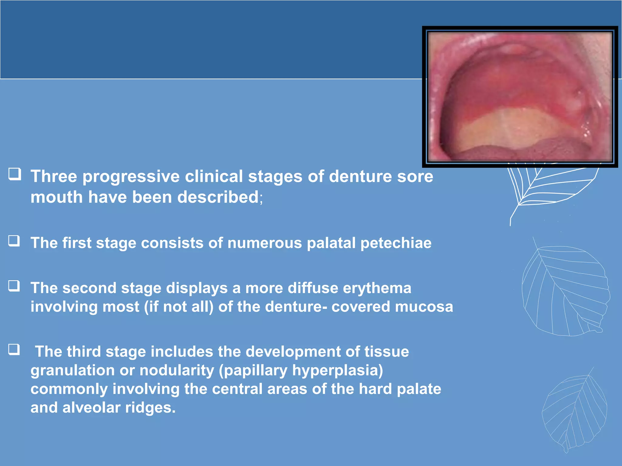 Denture induced lesions- Aarti Dubey | PPT
