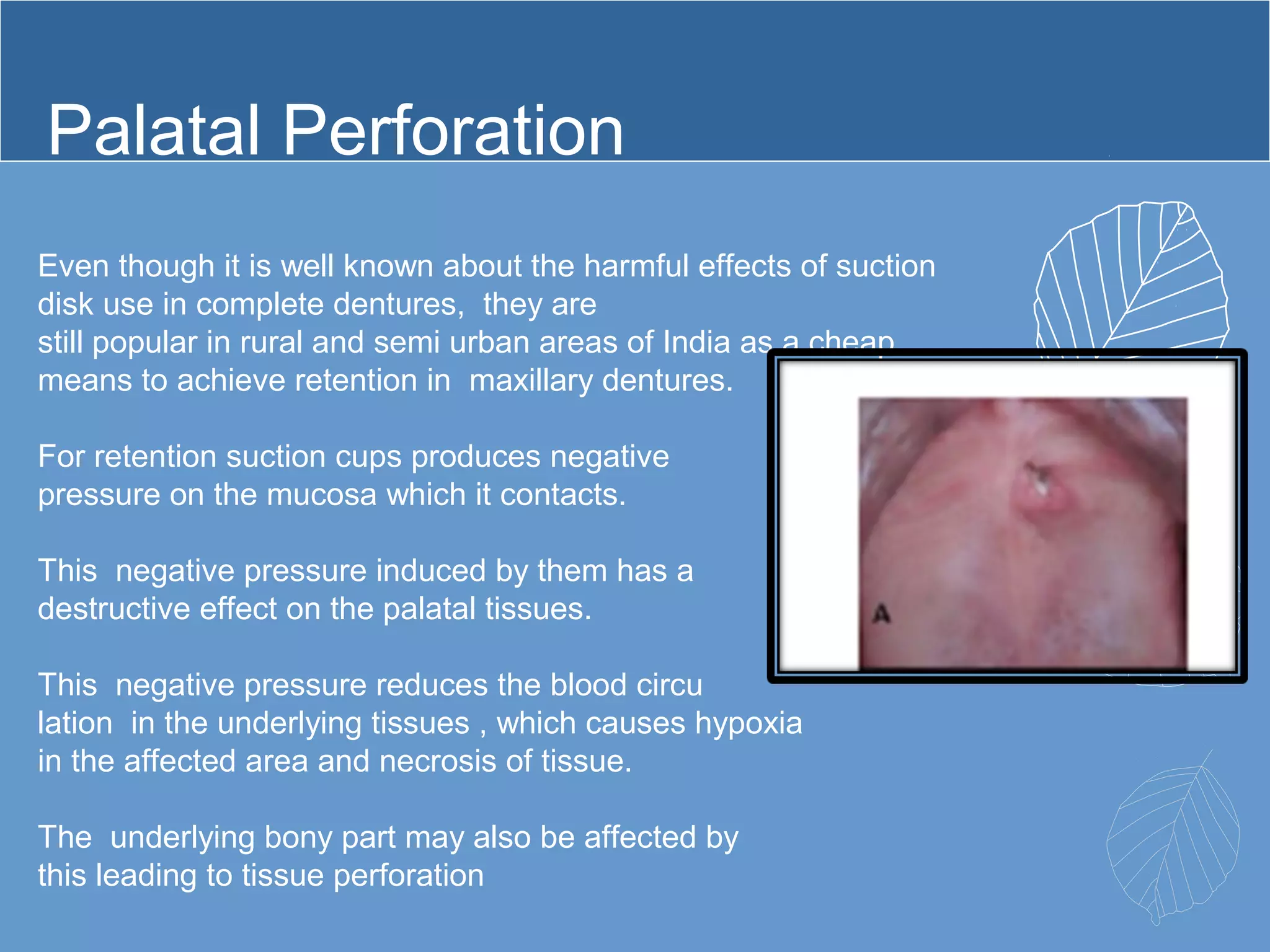 Denture induced lesions- Aarti Dubey | PPT
